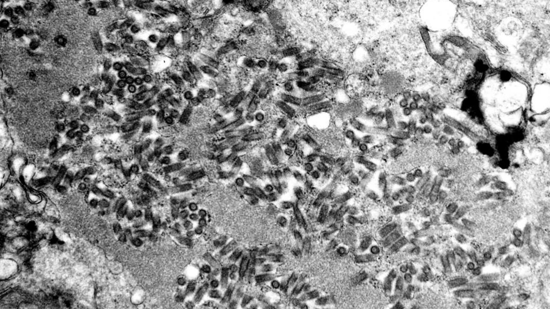 CDC reports Michigan man died after organ transplant from donor with ...