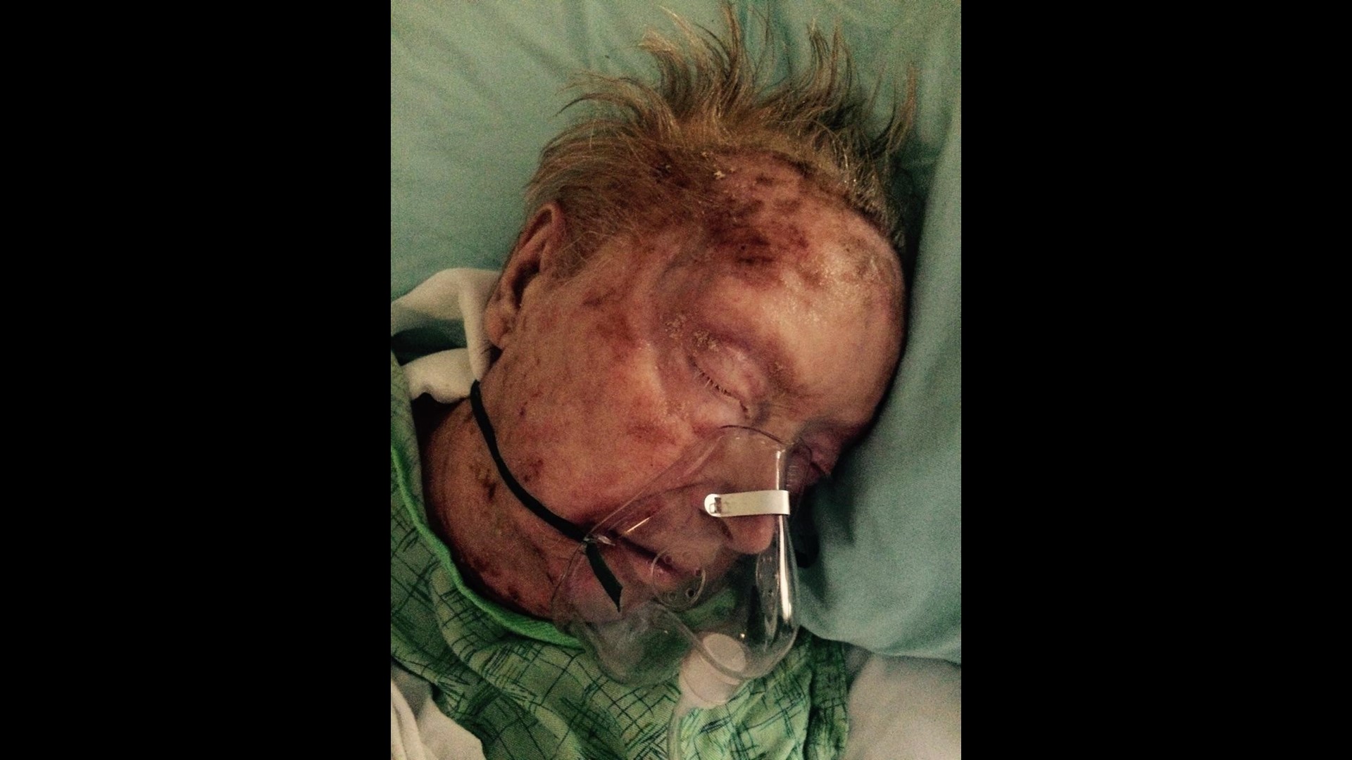 'Worst case she'd ever seen' | Another nursing home resident eaten ...