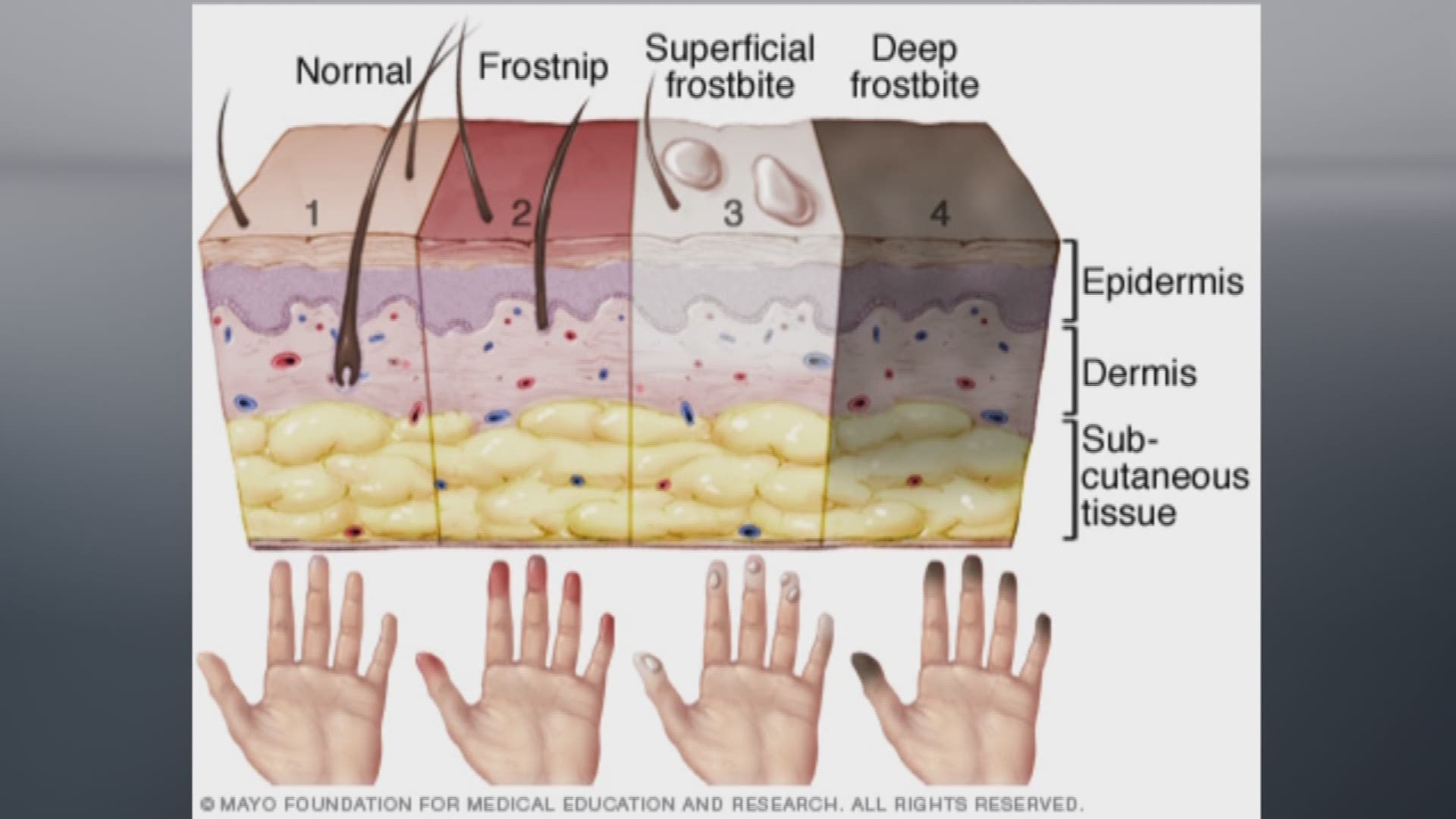 What to do about frostbite | wzzm13.com