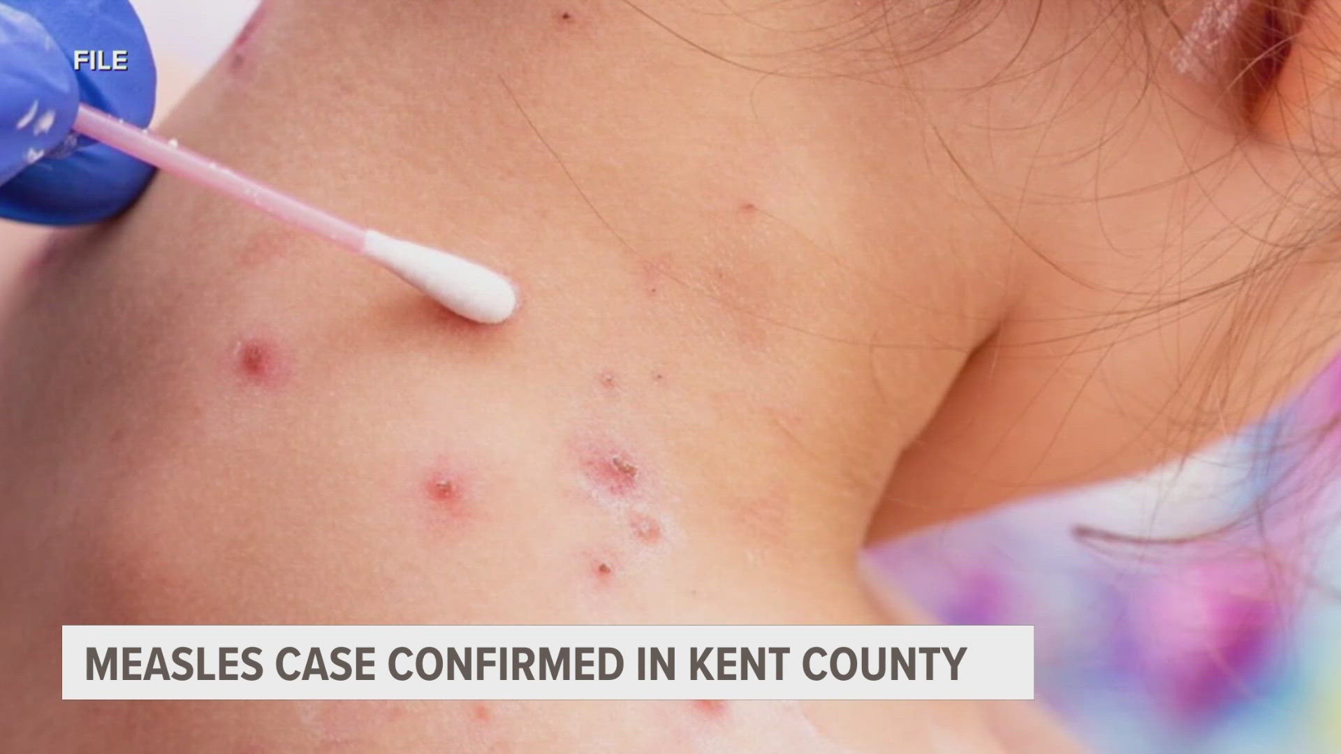 Measles case confirmed in Kent County for the first time since 2013 ...