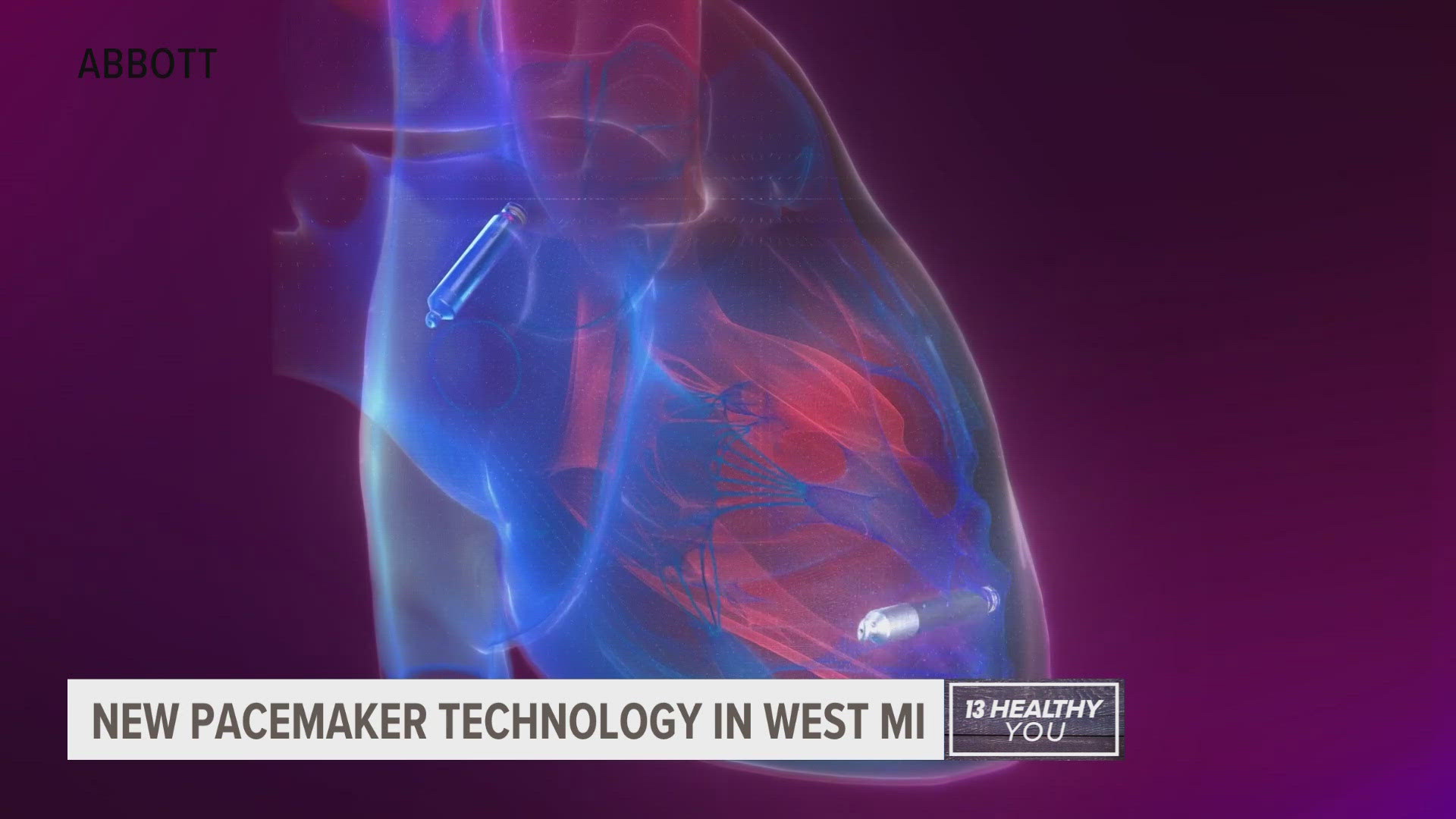 West MI hospital implants new pacemaker technology | wzzm13.com