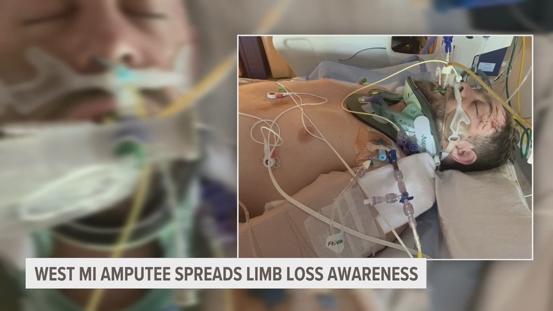 West MI man shares story of losing his leg, inspires other amputees ...